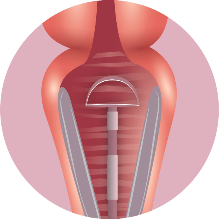 Cervical Cancer: Causes, symptoms, myths & facts & more